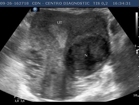 Miomas | CDN – Centro Diagnóstico Niterói